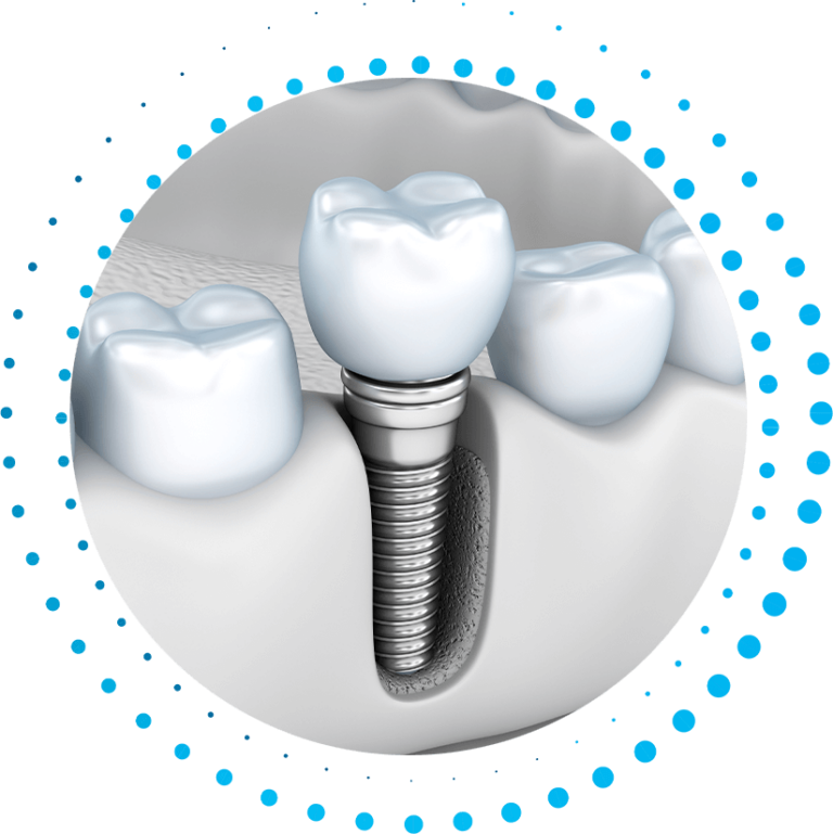 Heartland Oral Surgery & Dental Implants | Dentist | Kearney, NE ...