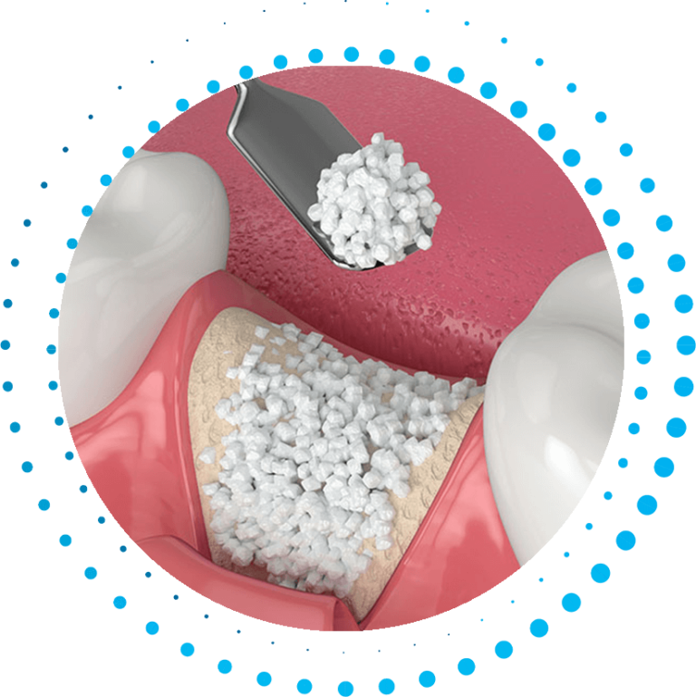 Bone Grafting | Kearney, NE | Grand Island, NE | Heartland Oral Surgery